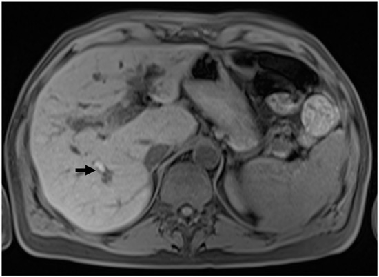 Primary Sclerosing Cholangitis: Diagnostic Criteria