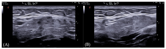 The Role of Major Salivary Gland Ultrasound in the Diagnostic Workup of ...