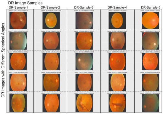 Identifying Diabetic Retinopathy in the Human Eye: A Hybrid Approach Based on a Computer-Aided ...