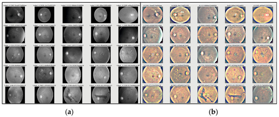 Identifying Diabetic Retinopathy in the Human Eye: A Hybrid Approach Based on a Computer-Aided ...