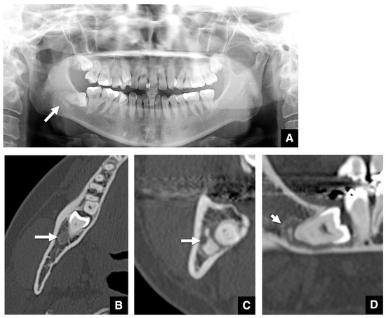 Imaging Characteristics of Embedded Tooth-Associated Cemento-Osseous ...