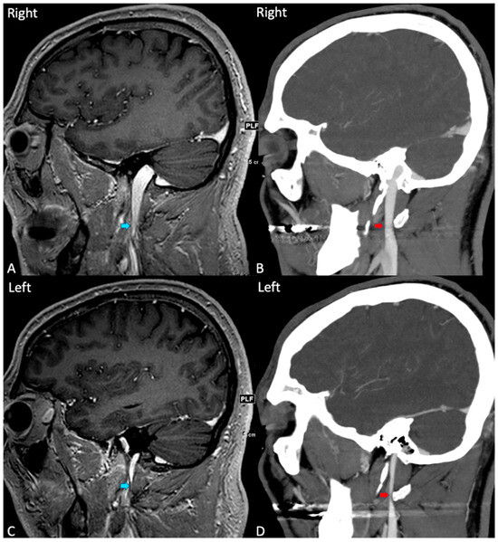Differential Assessment of Internal Jugular Vein Stenosis in Patients ...