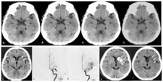 Detection of Hyperdense Arterial Sign in Acute Ischemic Stroke with ...