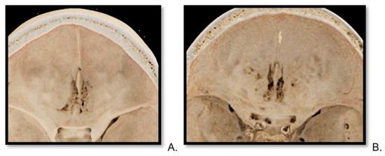 Photon Counting Computed Tomography for Accurate Cribriform Plate ...