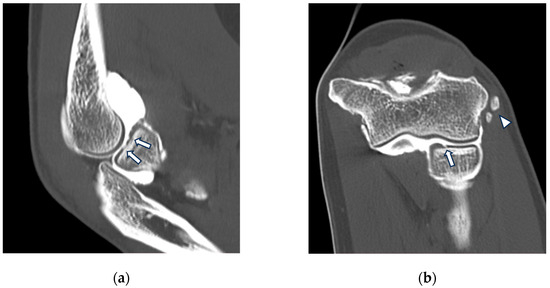 CT Arthrography of the Elbow: What Radiologists Should Know