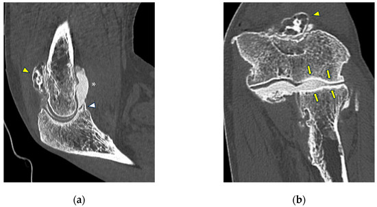 CT Arthrography of the Elbow: What Radiologists Should Know