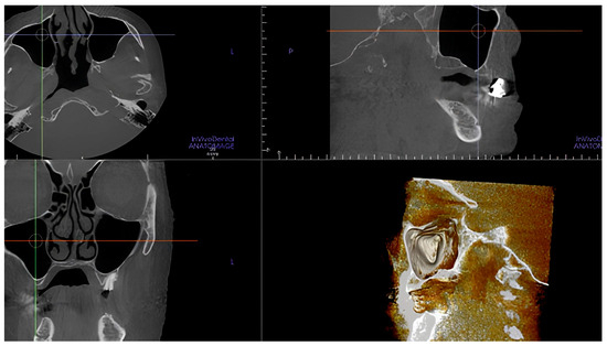 Anatomy of Maxillary Sinus: Focus on Vascularization and Underwood ...