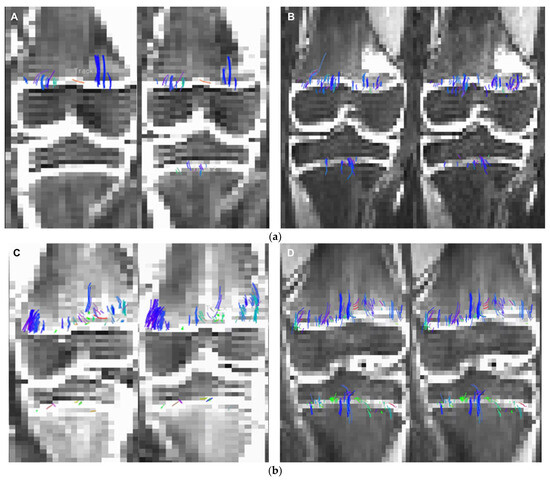 Impact of Deep Learning Denoising Algorithm on Diffusion Tensor Imaging of the Growth Plate on ...