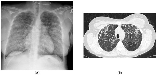 Uncommon Causes of Interlobular Septal Thickening on CT Images and ...