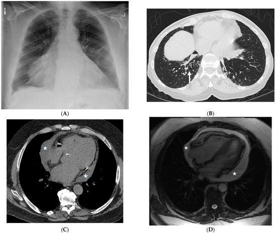 Uncommon Causes of Interlobular Septal Thickening on CT Images and ...
