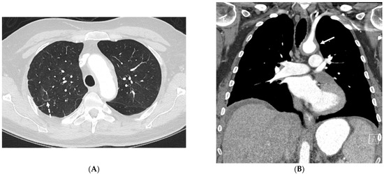 Uncommon Causes of Interlobular Septal Thickening on CT Images and ...