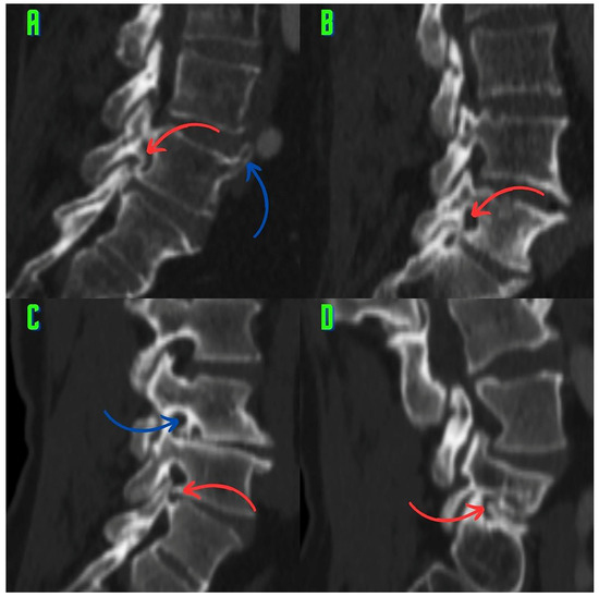 Classification of Osteophytes Occurring in the Lumbar Intervertebral ...