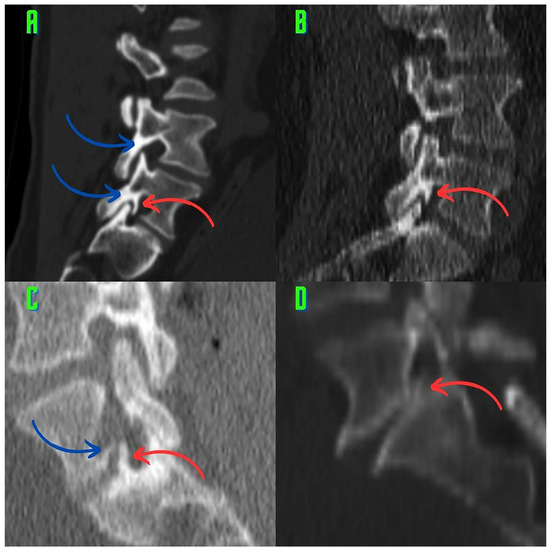 Classification of Osteophytes Occurring in the Lumbar Intervertebral ...