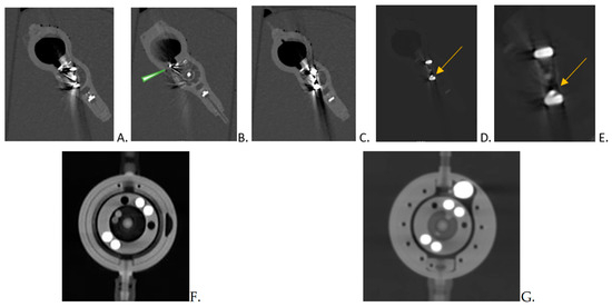 Advanced Imaging of Shunt Valves in Cranial CT Scans with Photon ...