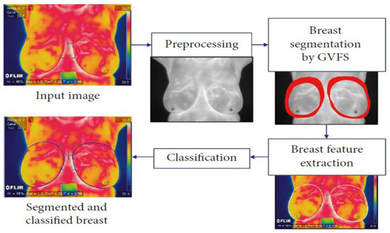 A Review of Artificial Intelligence in Breast Imaging