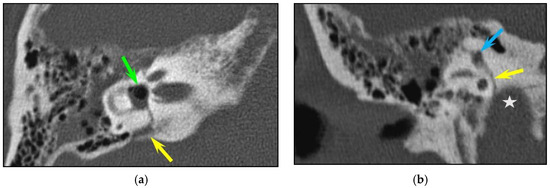 Temporal Bone Fractures and Related Complications in Pediatric and ...