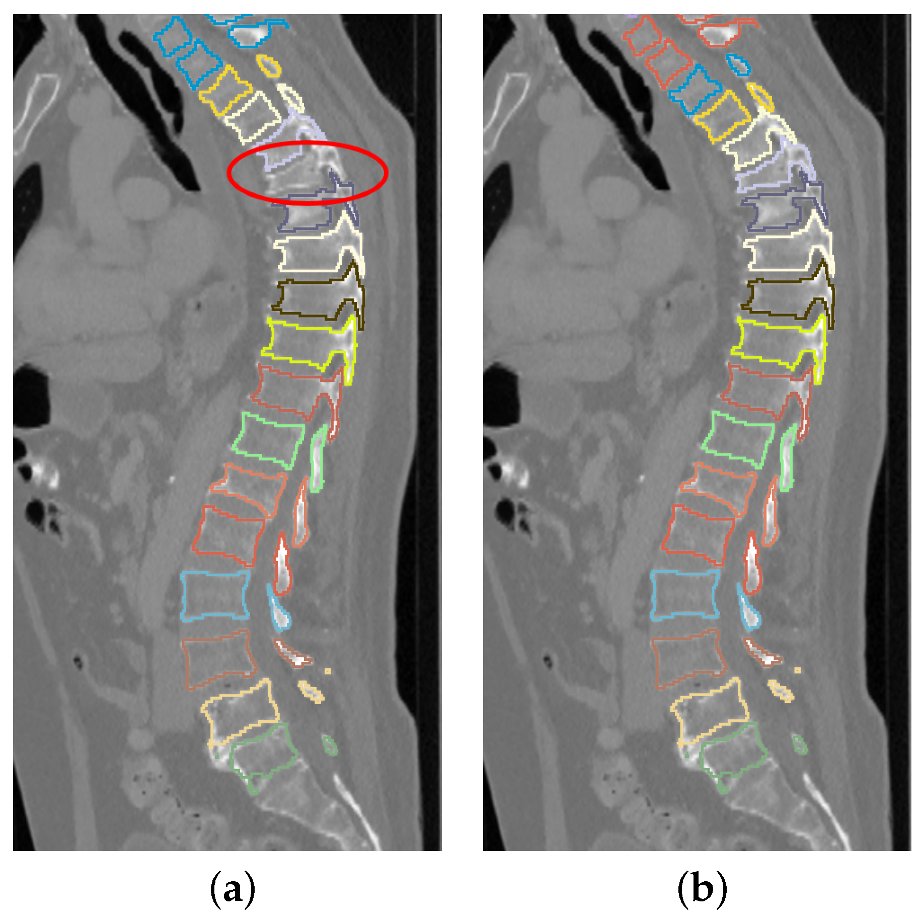 Lumbar and Thoracic Vertebrae Segmentation in CT Scans Using a 3D Multi-Object Localization and ...