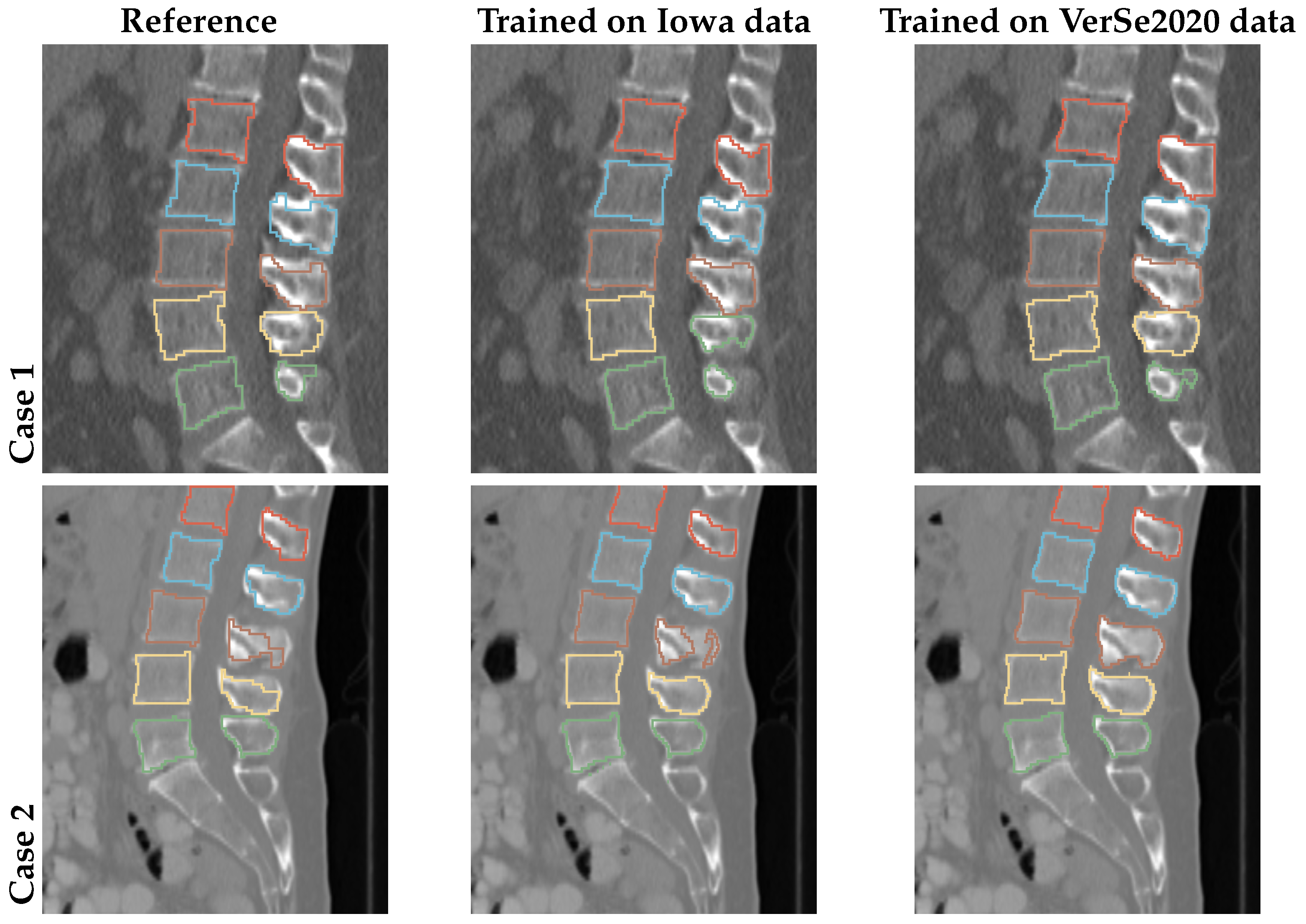 Lumbar and Thoracic Vertebrae Segmentation in CT Scans Using a 3D Multi-Object Localization and ...