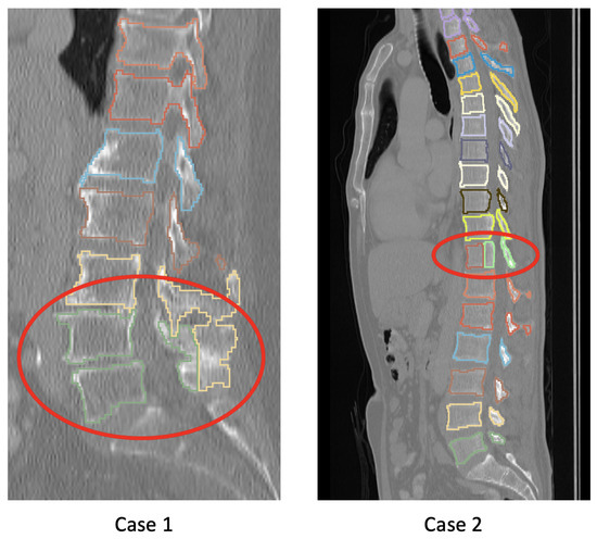 Lumbar and Thoracic Vertebrae Segmentation in CT Scans Using a 3D Multi-Object Localization and ...