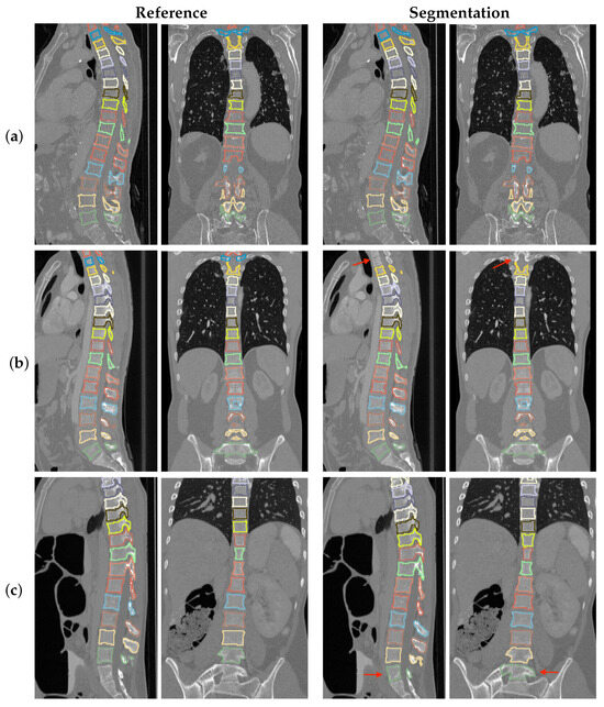 Lumbar and Thoracic Vertebrae Segmentation in CT Scans Using a 3D Multi ...