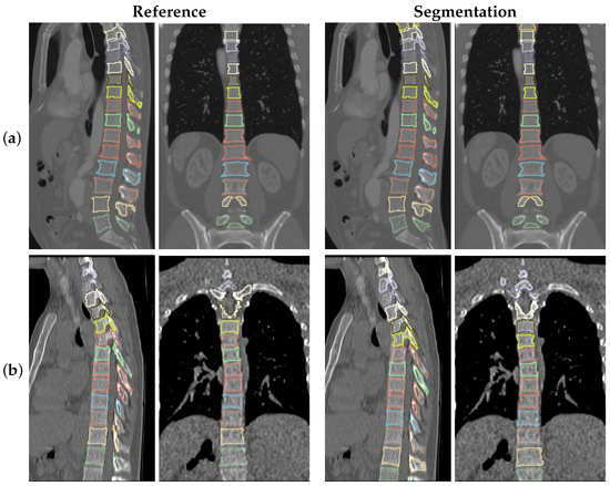 Lumbar and Thoracic Vertebrae Segmentation in CT Scans Using a 3D Multi-Object Localization and ...