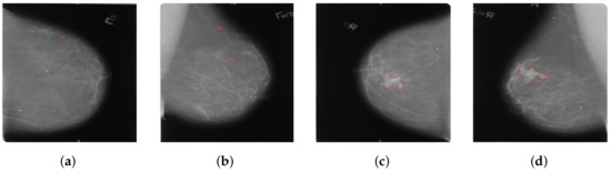 Breast Cancer Diagnosis Method Based on Cross-Mammogram Four-View ...