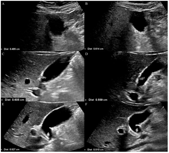 Comparison of the Size Measurement of Gallbladder Polyps by Three ...