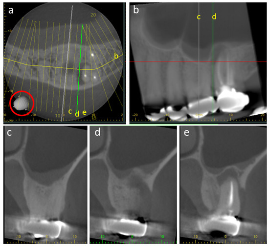 An Overview of Cone-Beam Computed Tomography and Dental Panoramic ...