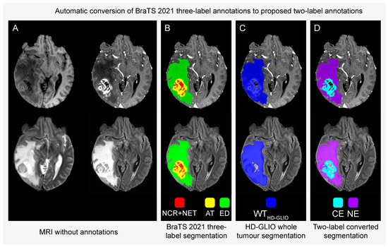 Repurposing the Public BraTS Dataset for Postoperative Brain Tumour ...