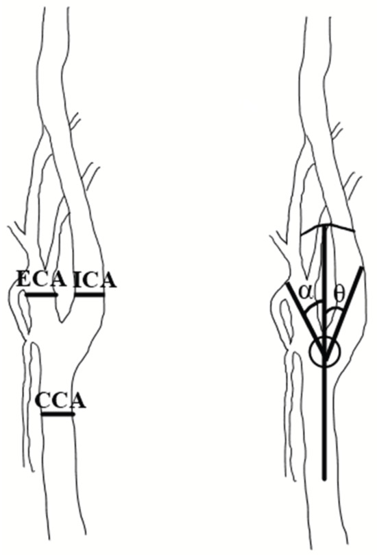 Super Learner Algorithm for Carotid Artery Disease Diagnosis: A Machine ...