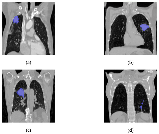 A Hybrid CNN-Transformer Model for Predicting N Staging and Survival in ...