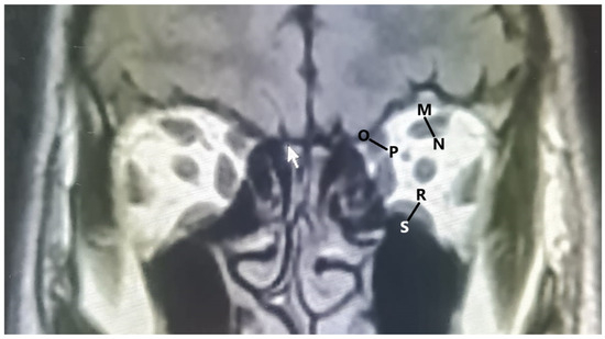 Evaluation of the Normal Measurements of Orbital Structures in Healthy ...