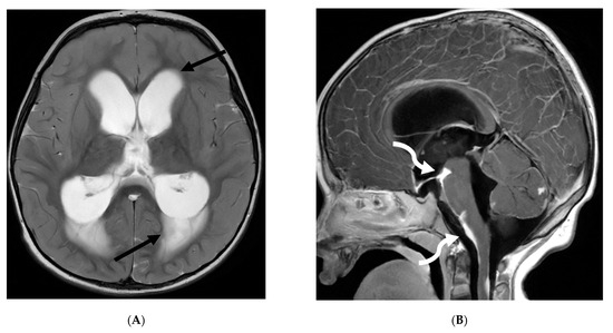 Pediatric Meningeal Diseases: What Radiologists Need to Know