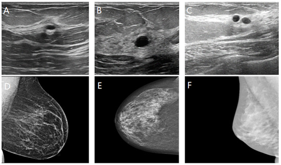 CNN-Based Cross-Modality Fusion for Enhanced Breast Cancer Detection ...