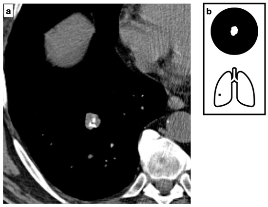 Calcified Lung Nodules: A Diagnostic Challenge in Clinical Daily Practice