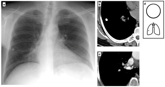 Calcified Lung Nodules: A Diagnostic Challenge in Clinical Daily Practice
