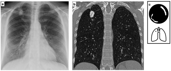 Calcified Lung Nodules: A Diagnostic Challenge in Clinical Daily Practice