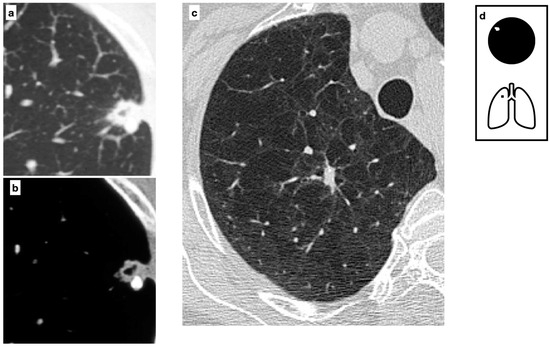 Calcified Lung Nodules: A Diagnostic Challenge in Clinical Daily Practice