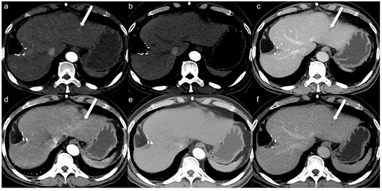 Image Quality and Lesion Detectability with Low-Monoenergetic Imaging: A Study of Low ...