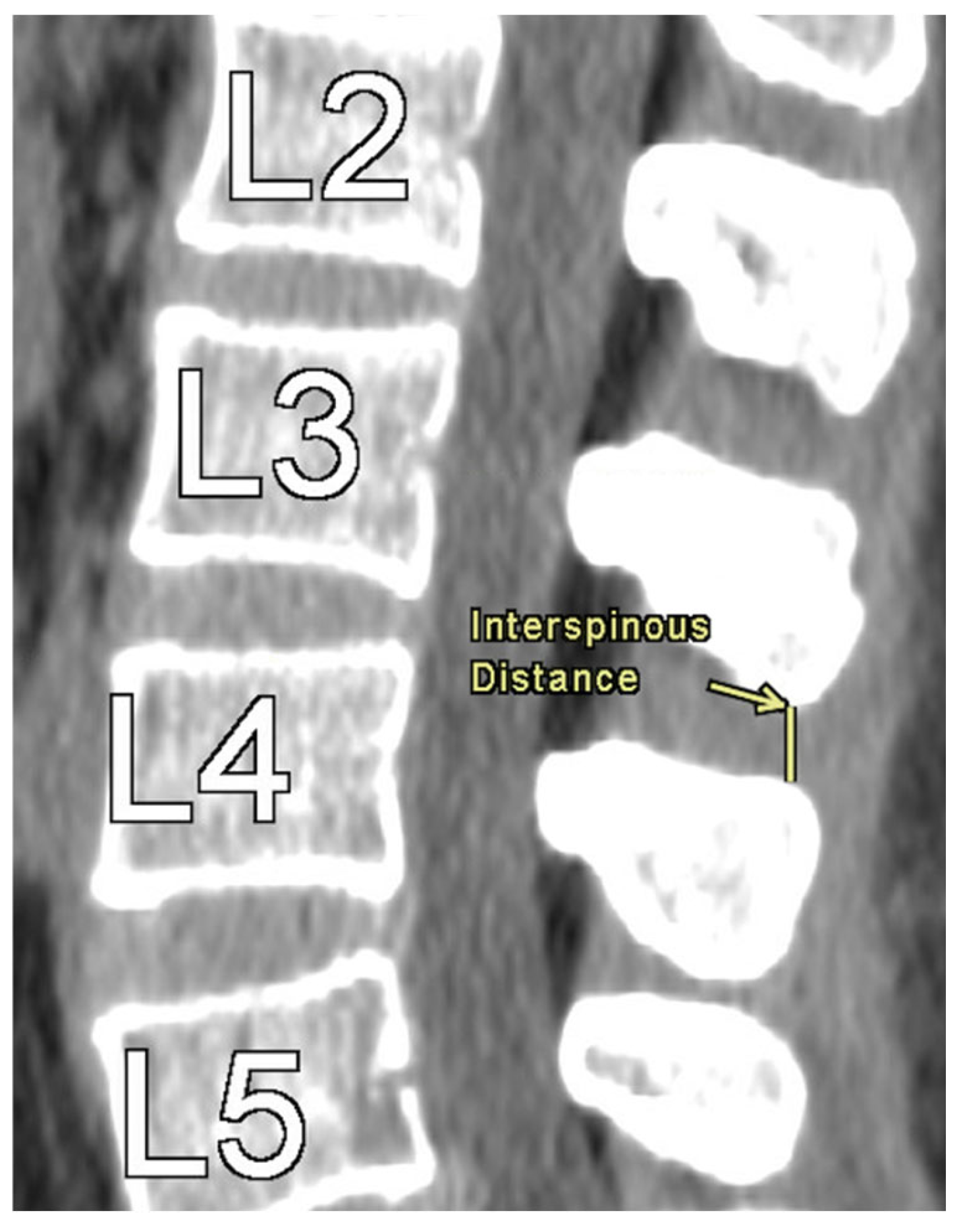Correlations of Lumbar Interspinous Distance with Neuroforaminal ...