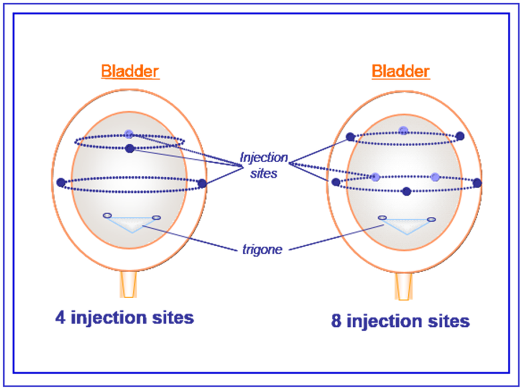 Does Reduction of Number of Intradetrusor Injection Sites of aboBoNTA ...