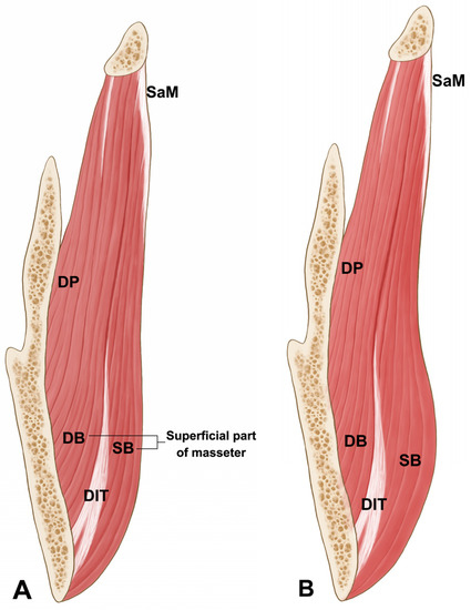 The Anatomical Basis of Paradoxical Masseteric Bulging after Botulinum ...