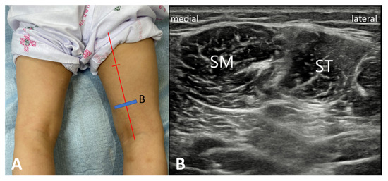 Botulinum Toxin Type A Injections Impact Hamstring Muscles and Gait ...