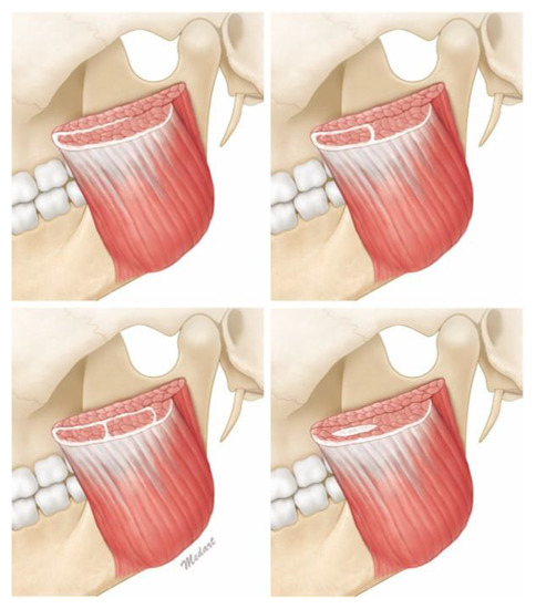 Anatomical Considerations When Treating Compensatory Hypertrophy of the ...