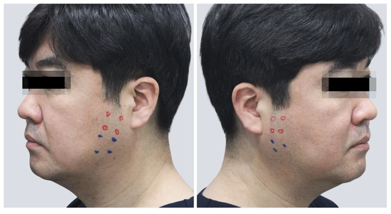 Anatomical Considerations When Treating Compensatory Hypertrophy of the ...