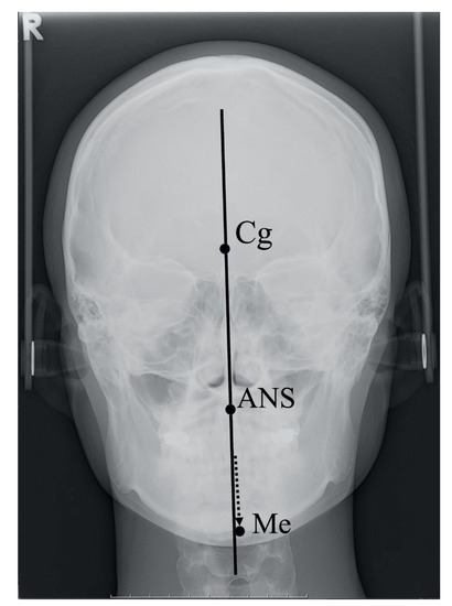 Effect of Botulinum Toxin Injection on Asymmetric Lower Face with Chin ...