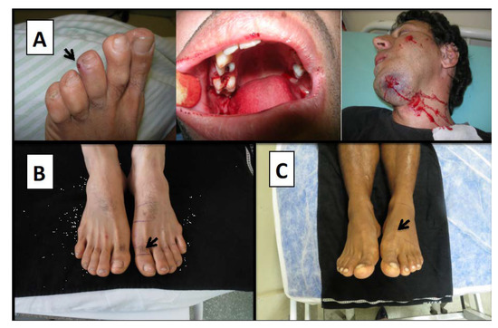 Current Knowledge on Snake Dry Bites