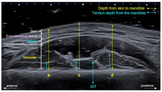 Toxins | Free Full-Text | Ultrasonographic Considerations for Safe and ...