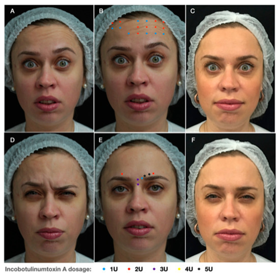 Botulinum Toxin Type A to Improve Facial Symmetry in Facial Palsy: A ...