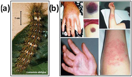 Lonomia obliqua Envenoming and Innovative Research